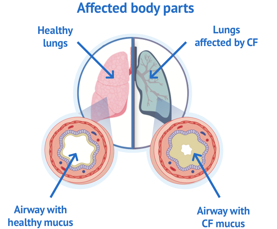 What is Cystic Fibrosis? | Pulmozyme® (dornase alfa)